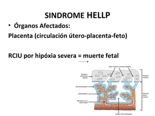 Sindrome hellp | PPT