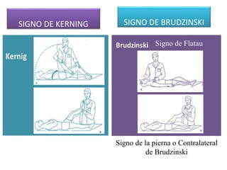 SINDROME MENINGEO. SINDROME DE HIPERTENSION ENDOCRANEANA | PPT