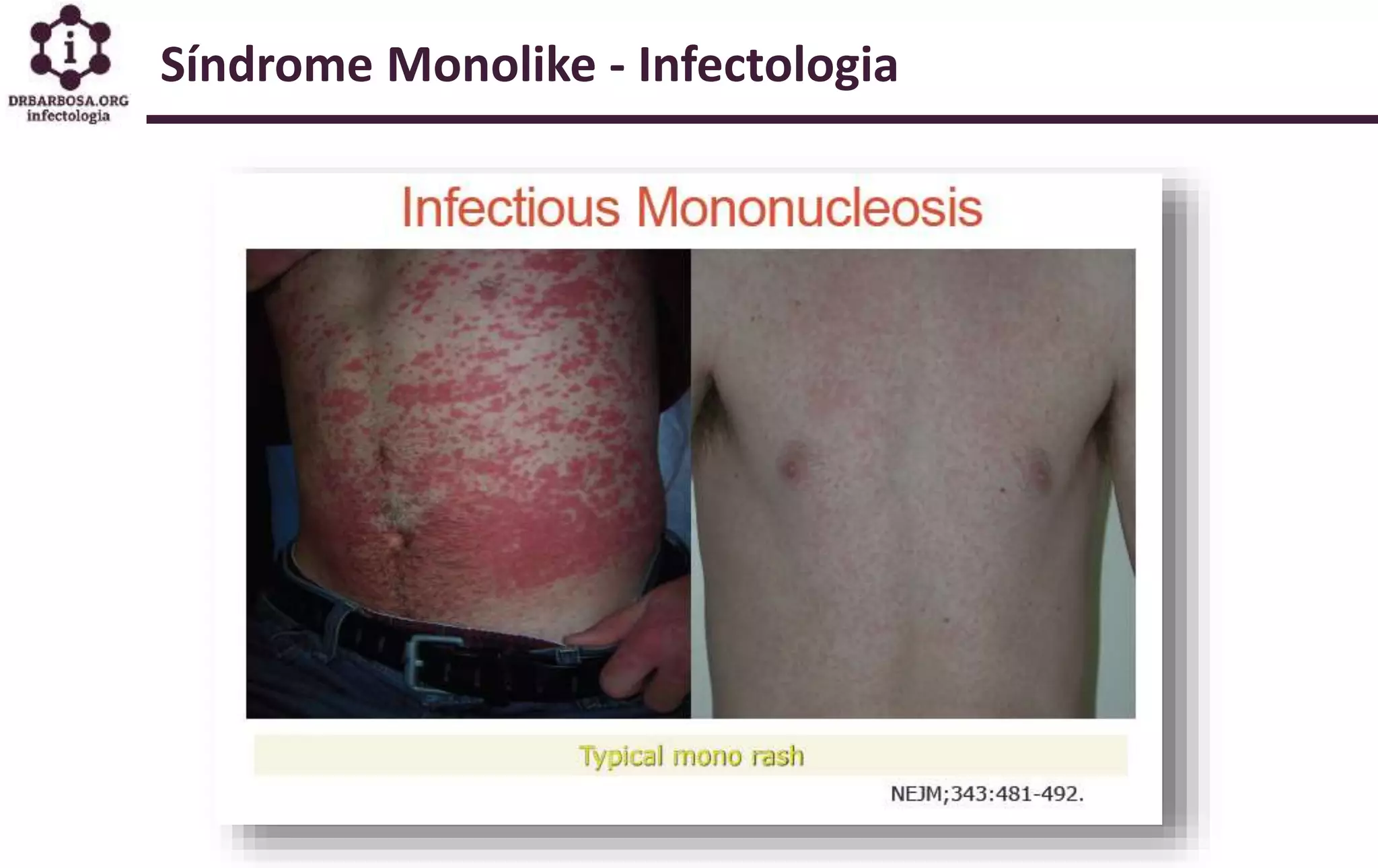 Sindrome Monolike - Linfoadenopatia Febril - Mononucleose Infecciosa ...