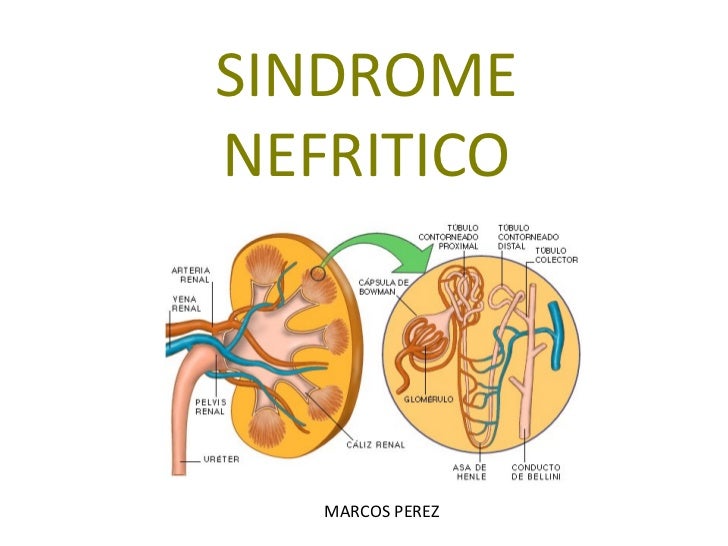 Sindrome Nefritico