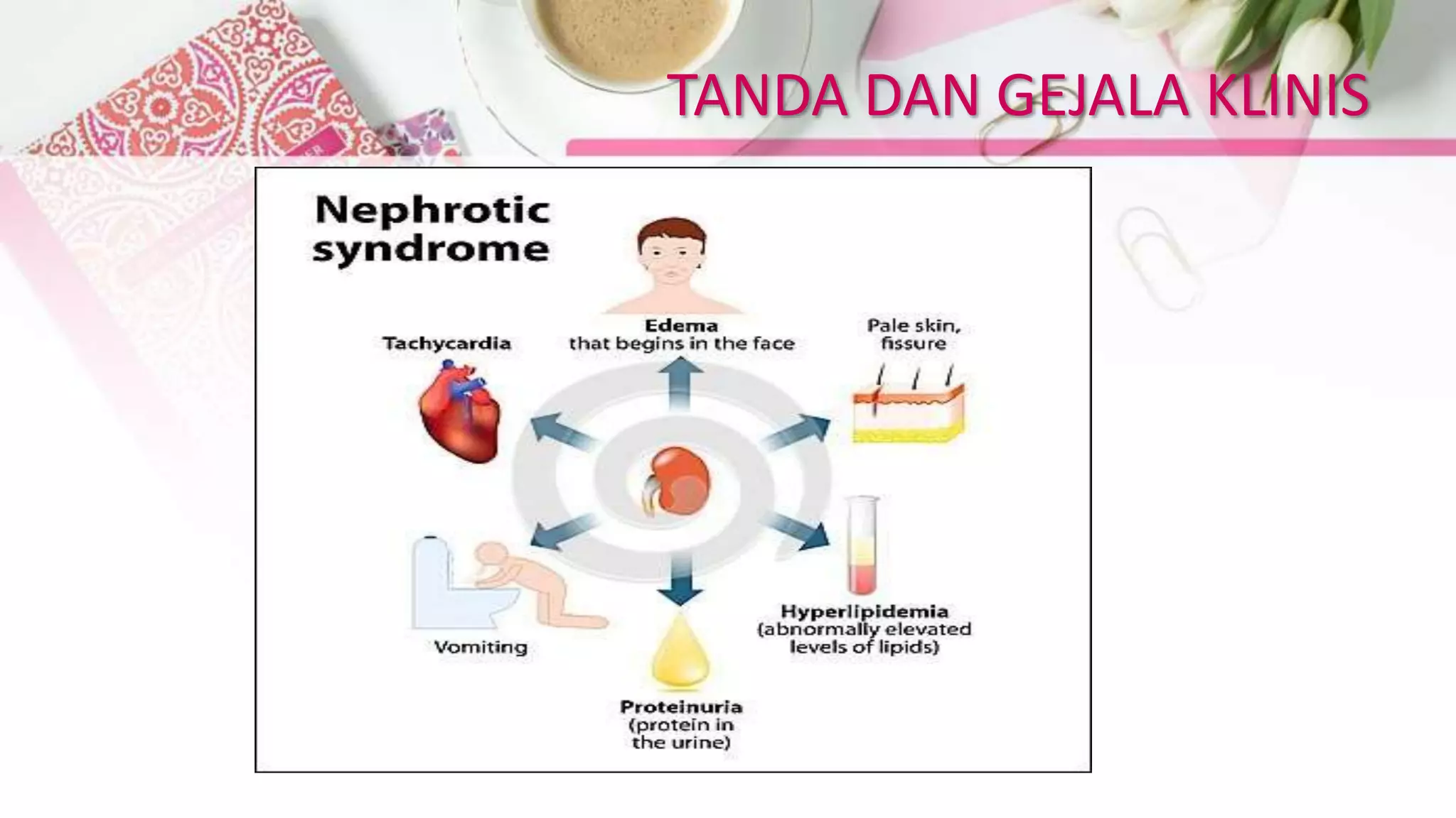 Sindrome nefrotik | PPTX