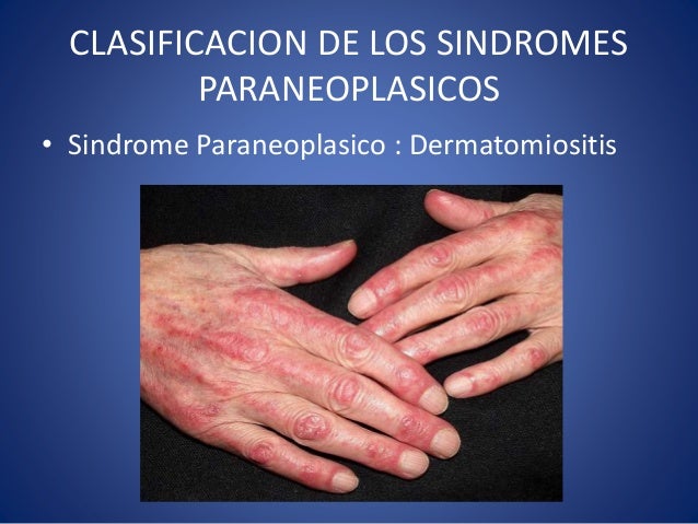 SINDROME PARANEOPLASICO PDF