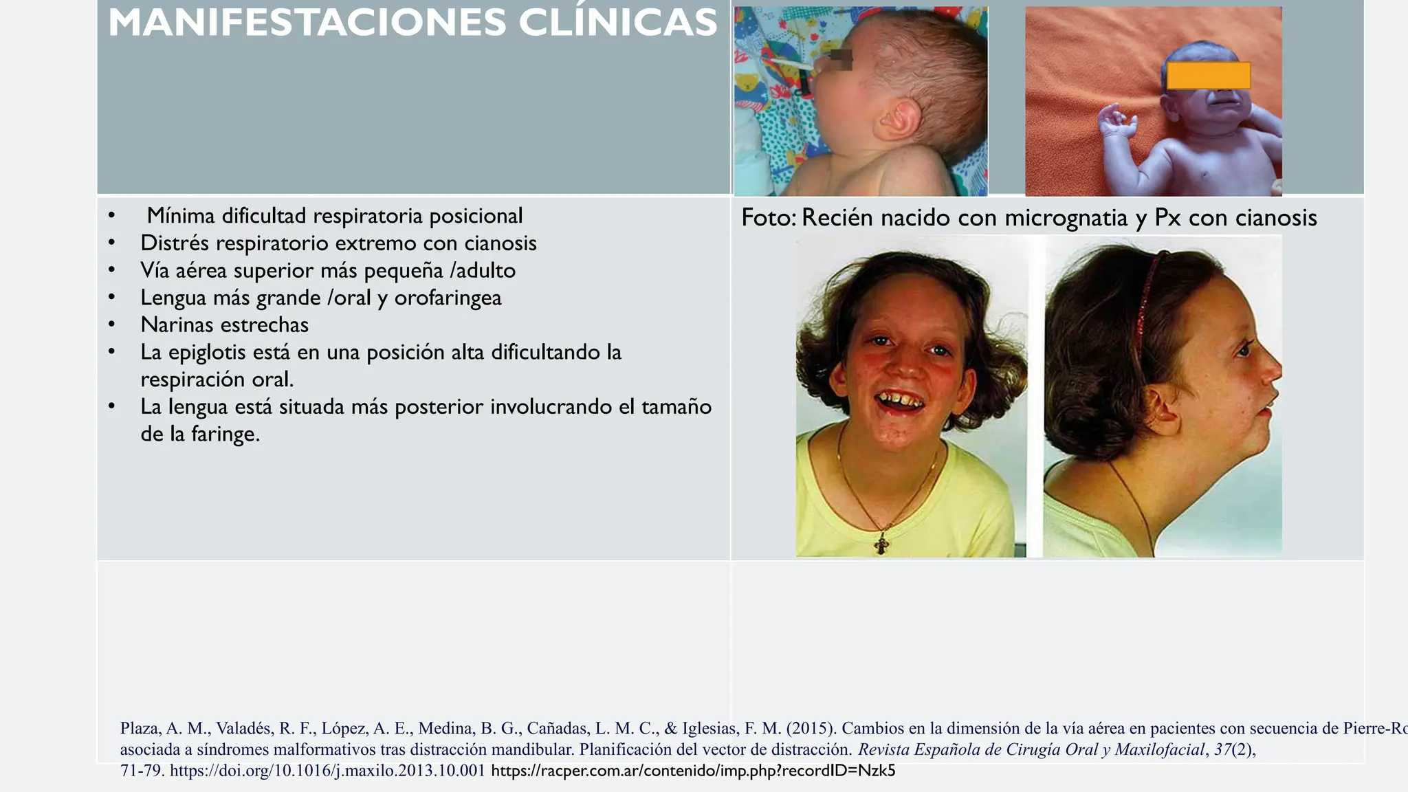 SINDROME PIERRE ROBIN presentación del síndrome para estudio | PPTX