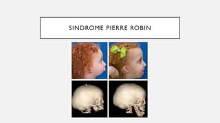 SINDROME PIERRE ROBIN presentación del síndrome para estudio | PPTX