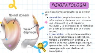 SINDROME PILORICO, ILEO TODO ACERCA DE ESTO | PDF