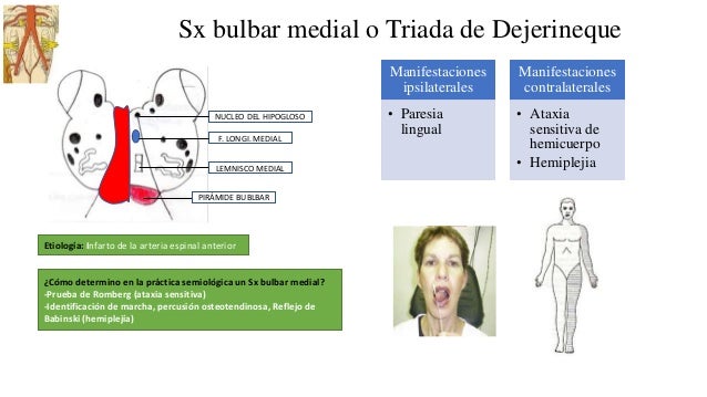 Síndromes del Tronco encefálico