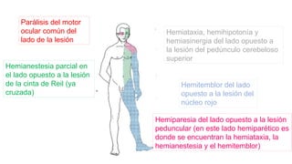 Sindromes alternos del tronco del encefalo.pptx