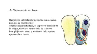 Sindromes alternos del tronco del encefalo.pptx