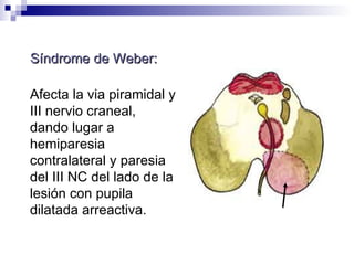 Sindromes alternos del tallo | PPT