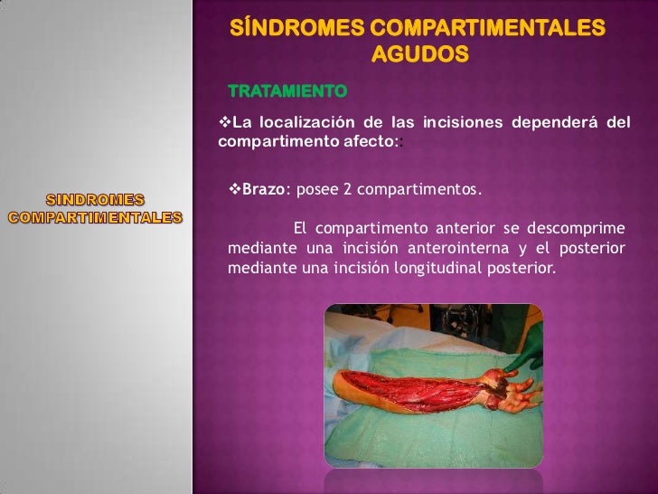 Sindromes compartimentales 1