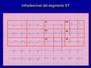 Sindromes Coronarios Agudos | PPT