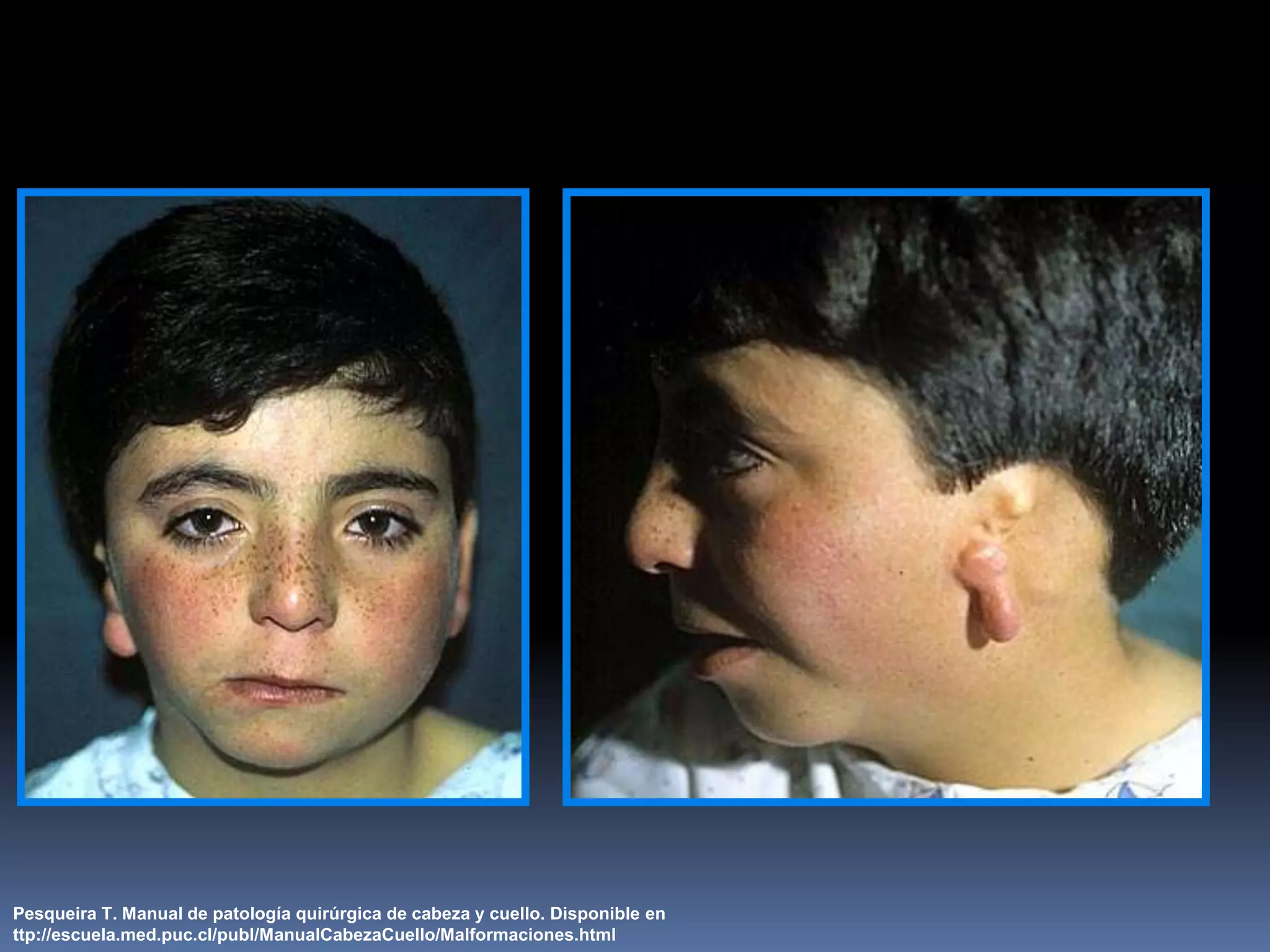 Sindromes del Desarrollo Craneofacial | PPTX