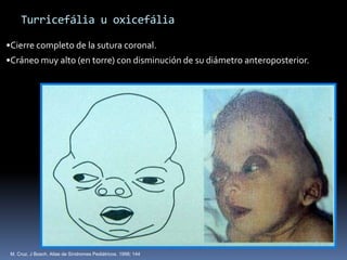 Sindromes del Desarrollo Craneofacial | PPTX