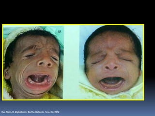 Sindromes del Desarrollo Craneofacial | PPTX
