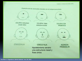 Sindromes del Desarrollo Craneofacial | PPTX