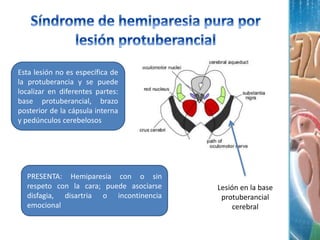 Síndromes del tronco cerebral | PPTX