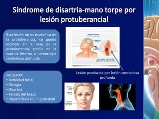 Síndromes del tronco cerebral | PPTX