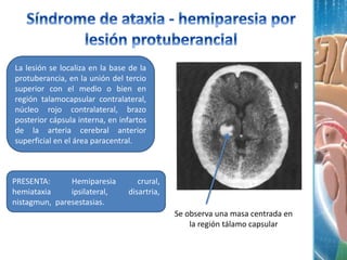 Síndromes del tronco cerebral | PPTX
