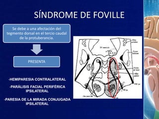 Síndromes del tronco cerebral | PPTX
