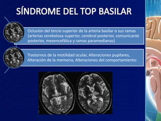 Síndromes del tronco cerebral | PPTX