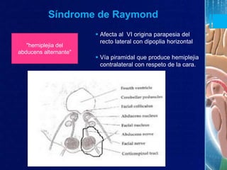 Síndromes del tronco cerebral | PPTX