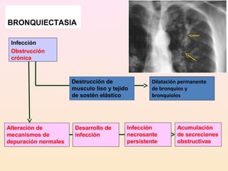 Sindromes Obstructivos By Md Jimena Aguilar Escobar Ppt