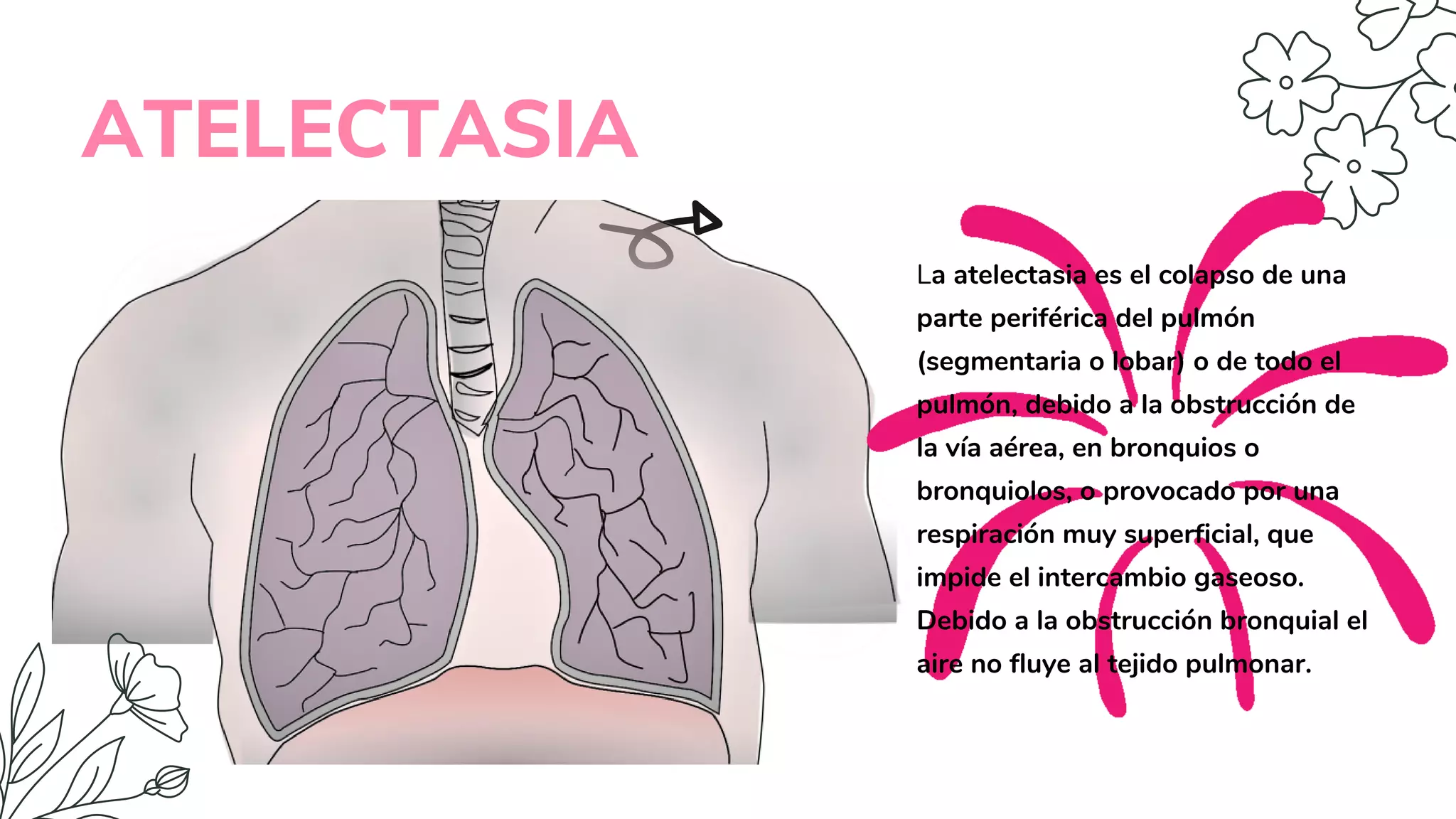 Sindromes pleuropulmonares.pdf
