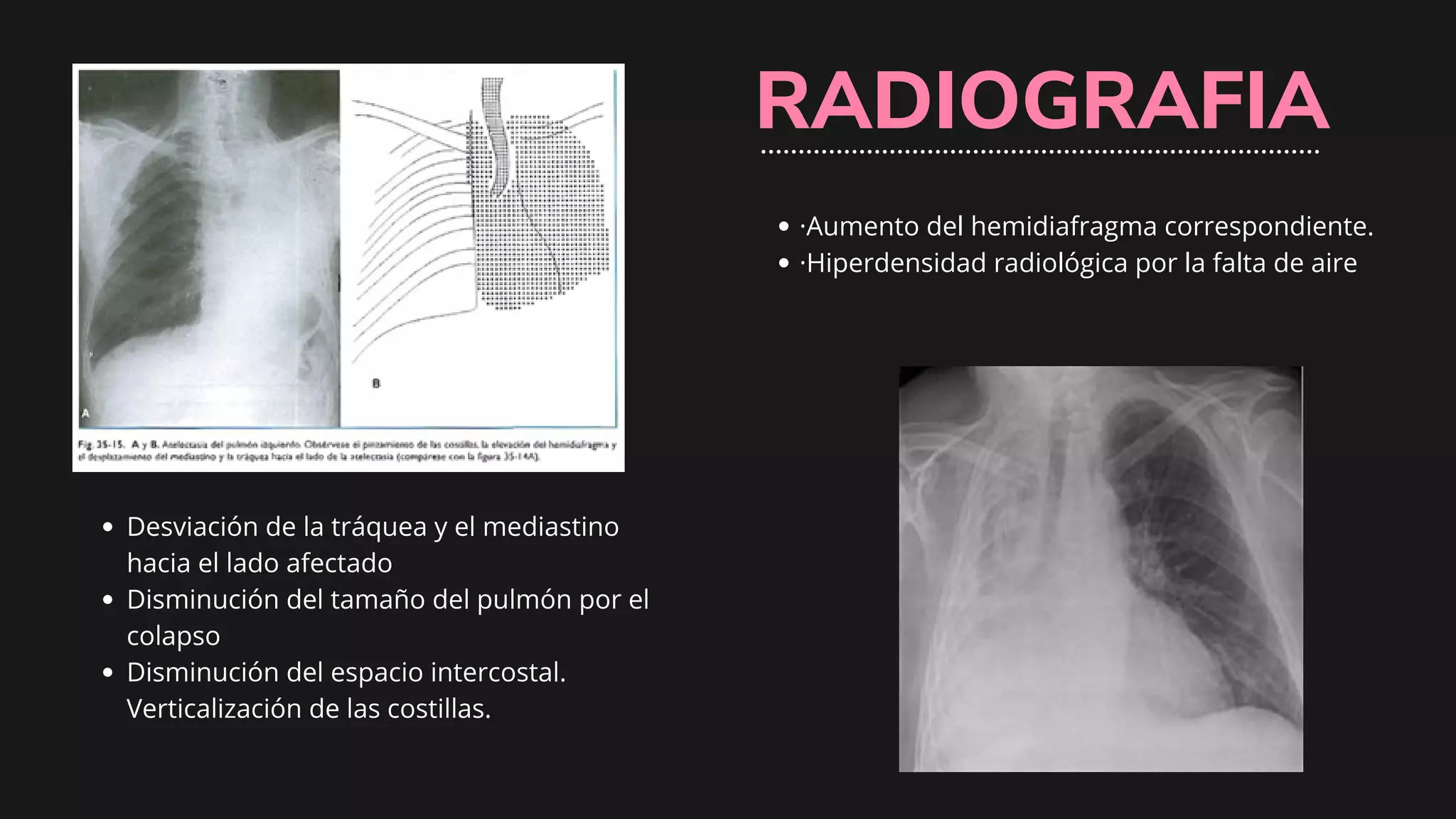 Sindromes pleuropulmonares.pdf