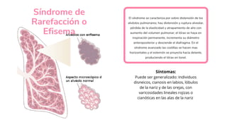 Sindromes pleuropulmonares.pdf