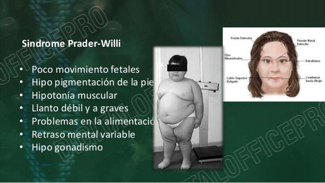 Sindromes prader willi y angelman