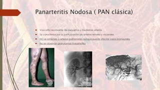 Sindromes vasculíticos. interna iii | PPTX