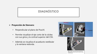 Sindromes vestibulares perifericos y meniere | PPTX