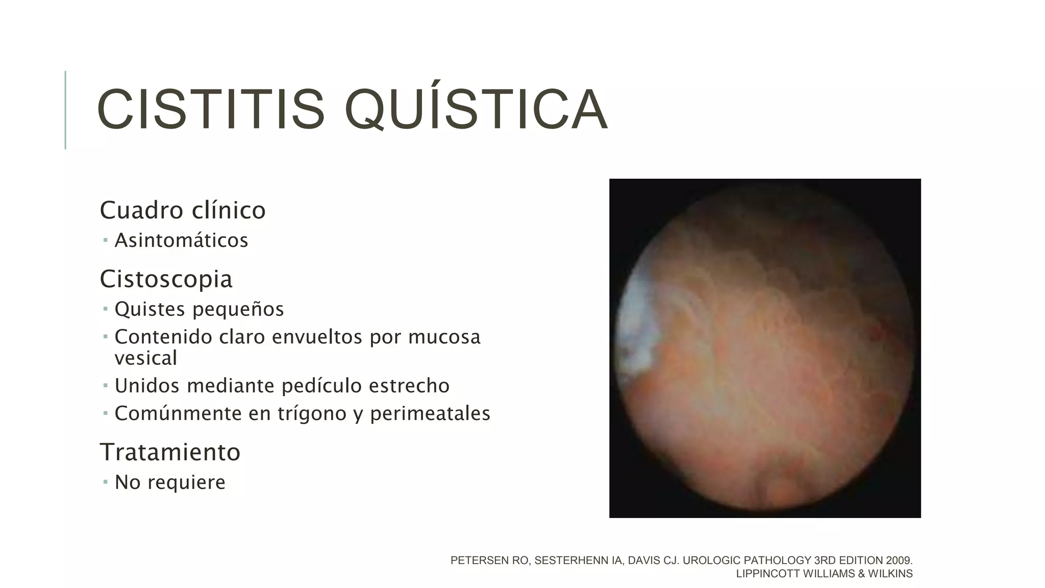 Sindrome uretral y otras Cistitis | PPTX