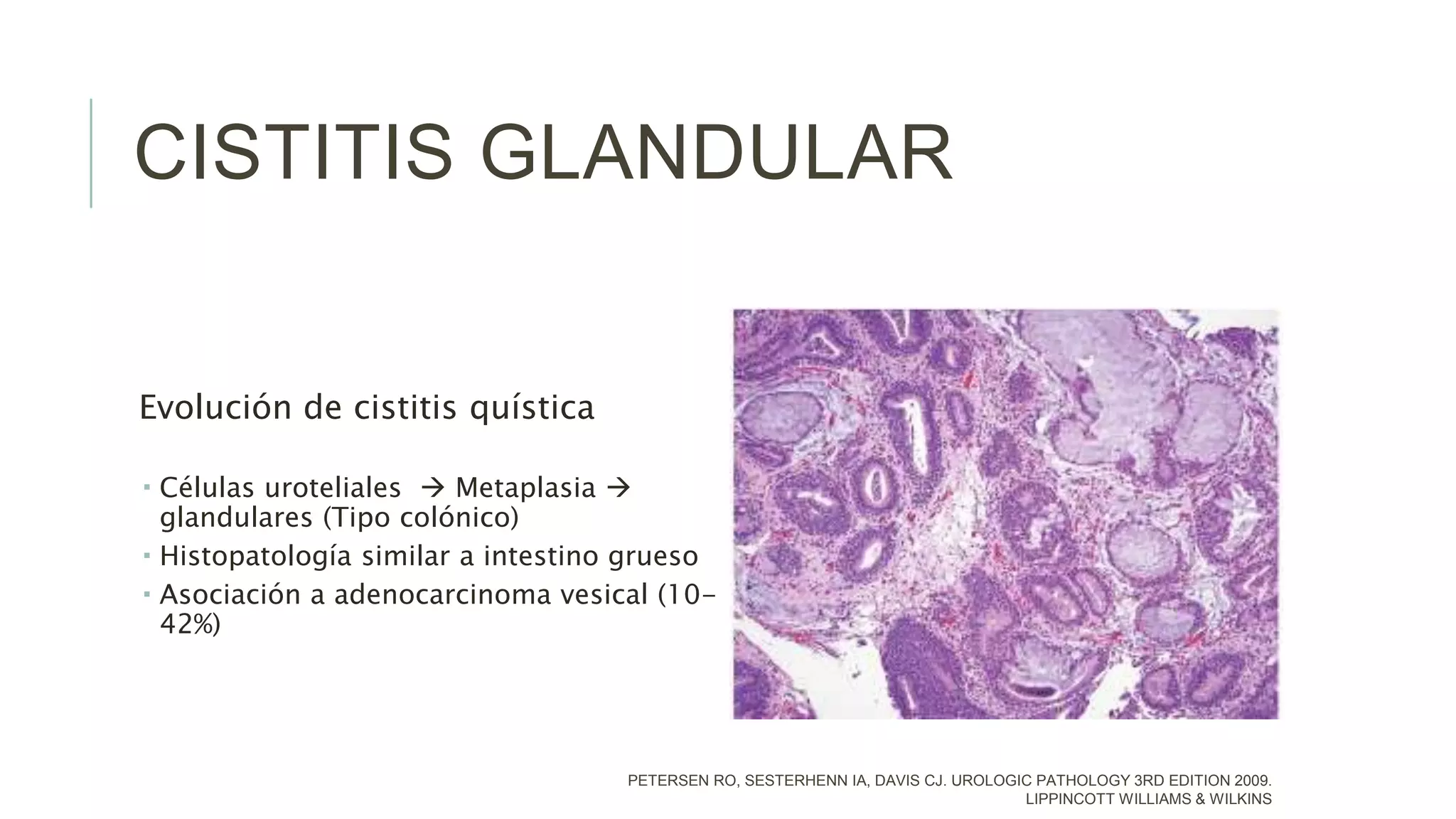Sindrome uretral y otras Cistitis | PPTX
