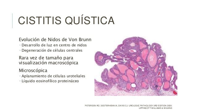 Sindrome uretral y otras Cistitis