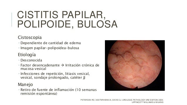 Sindrome uretral y otras Cistitis