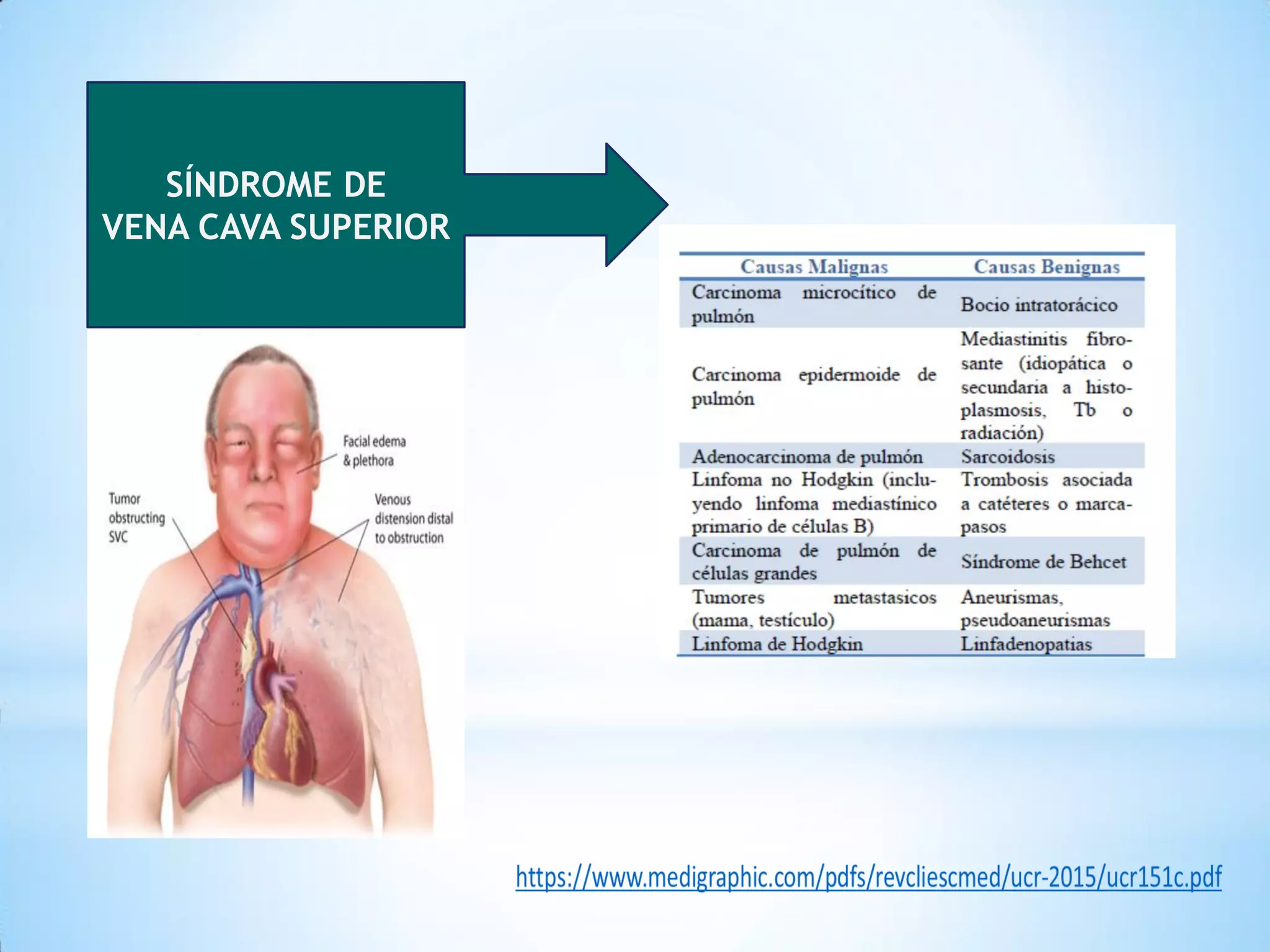 Sindrome vena cava superior | PDF