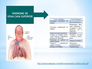 Sindrome vena cava superior | PDF