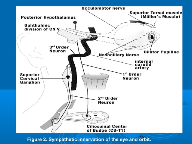 Sindrom horner | PPT
