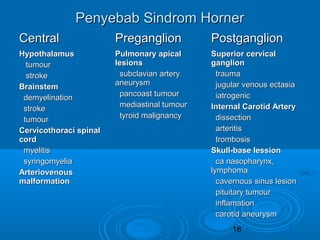 Sindrom horner | PPT