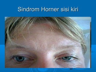 Sindrom horner | PPT