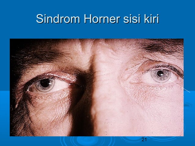 Sindrom horner | PPT