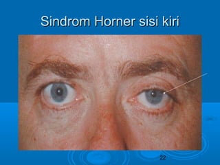 Sindrom horner | PPT