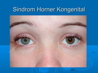 Sindrom horner | PPT