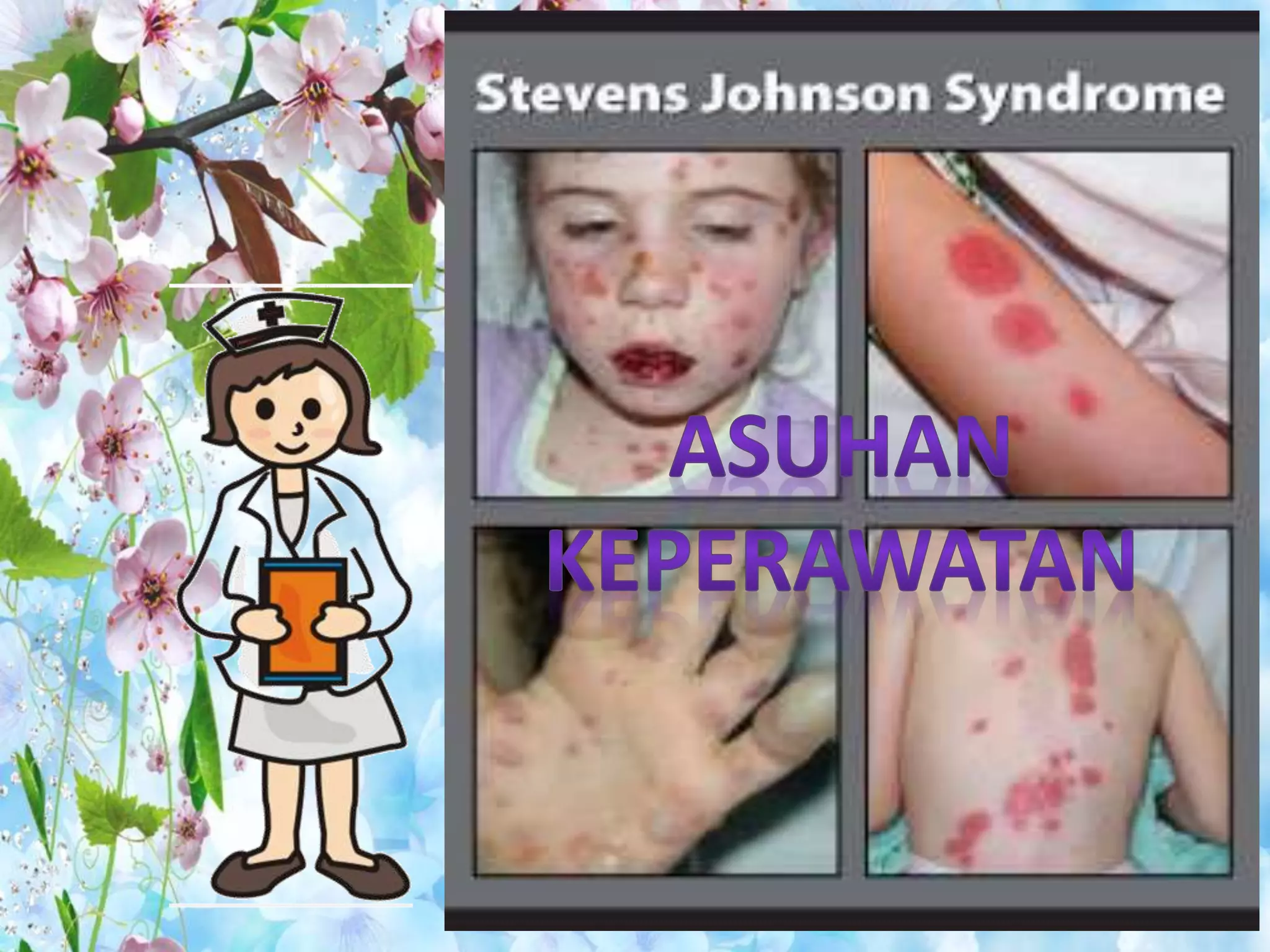 Sindrom steven johnson (ssj) | PPTX