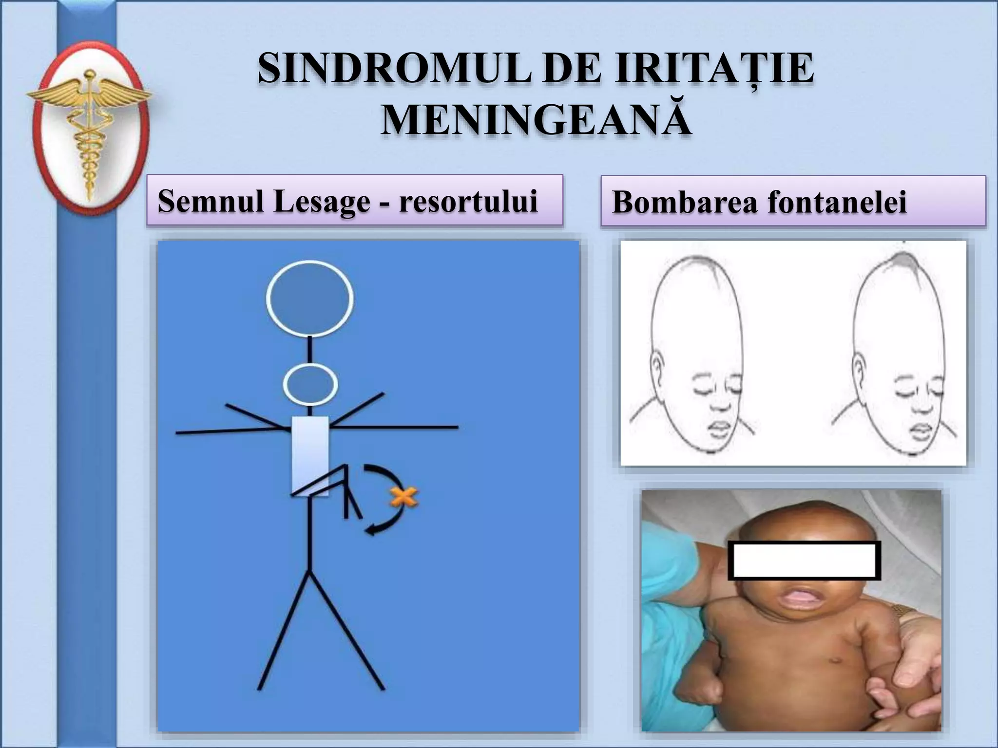 Sindromul de iritatie meningeana | PPTX