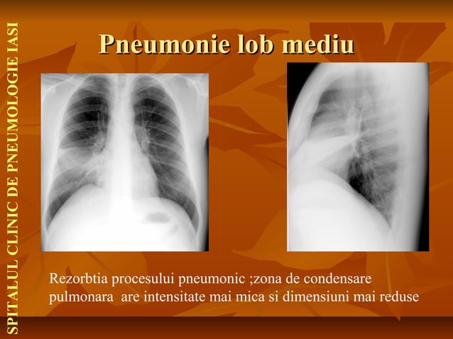 Sindromul de umplere alveolara | PPT