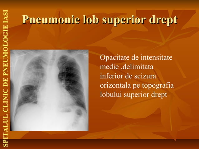 Sindromul de umplere alveolara | PPT