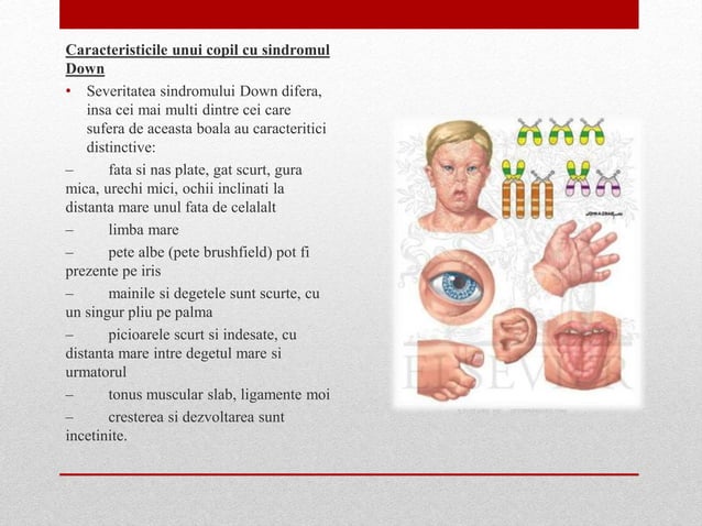 Sindromul down | PPTX