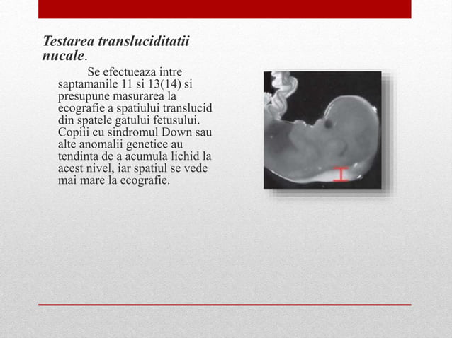 Sindromul down | PPTX